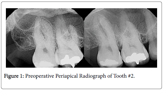 Complex Apical Anatomy Revealed Following Endodontic Treatment of