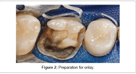 The Use Of Indirect Resin Composites In Clinical Practice: A Case