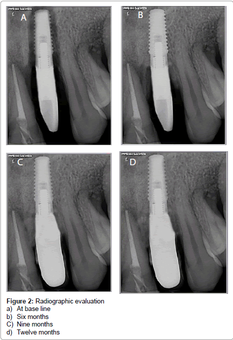 Radiographic Bone Changes Around Immediately Placed Immediately ...