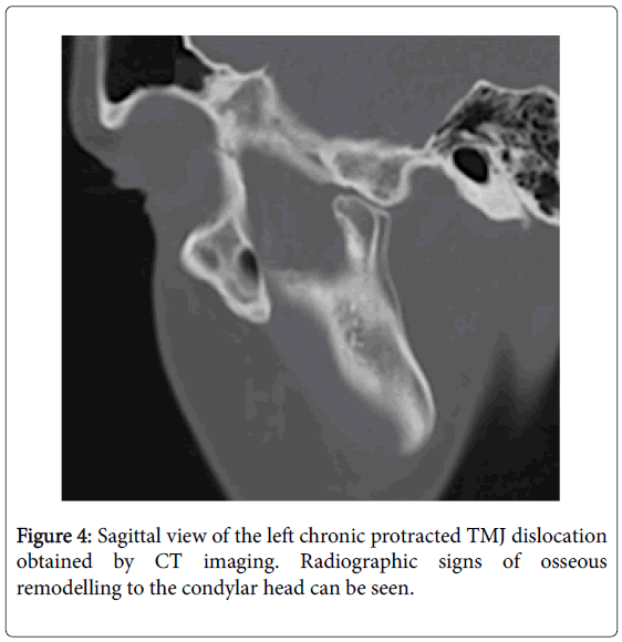 Surgical Management of Chronic and Refractory TMJ Dislocation in