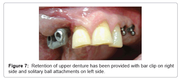 Implant Restoration in a Patient with Neurofibromatosis Type 1: A
