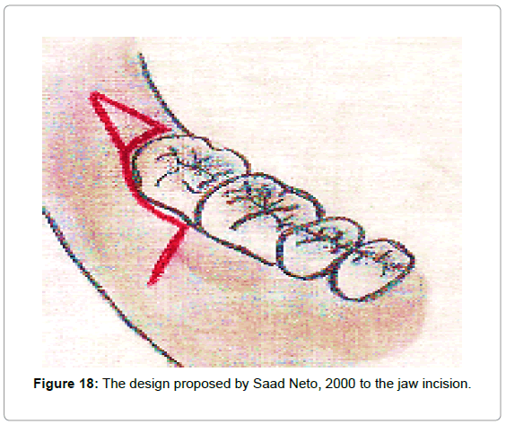 The Different Types of Flaps in the Surgical Relations of the Third ...