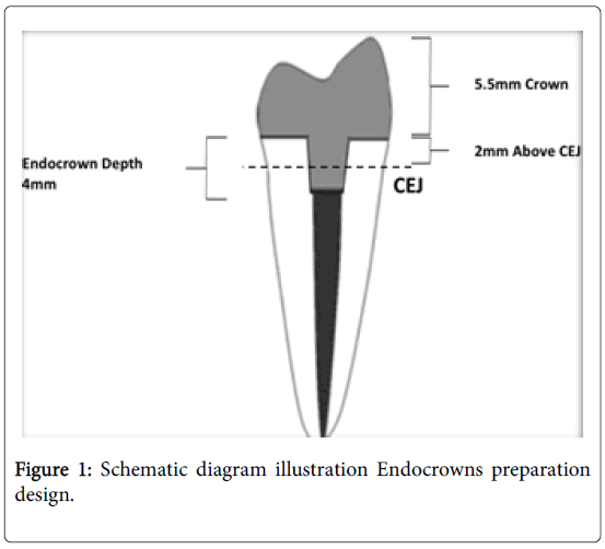 Fracture Resistance of Endodontically Treated Teeth Restored with
