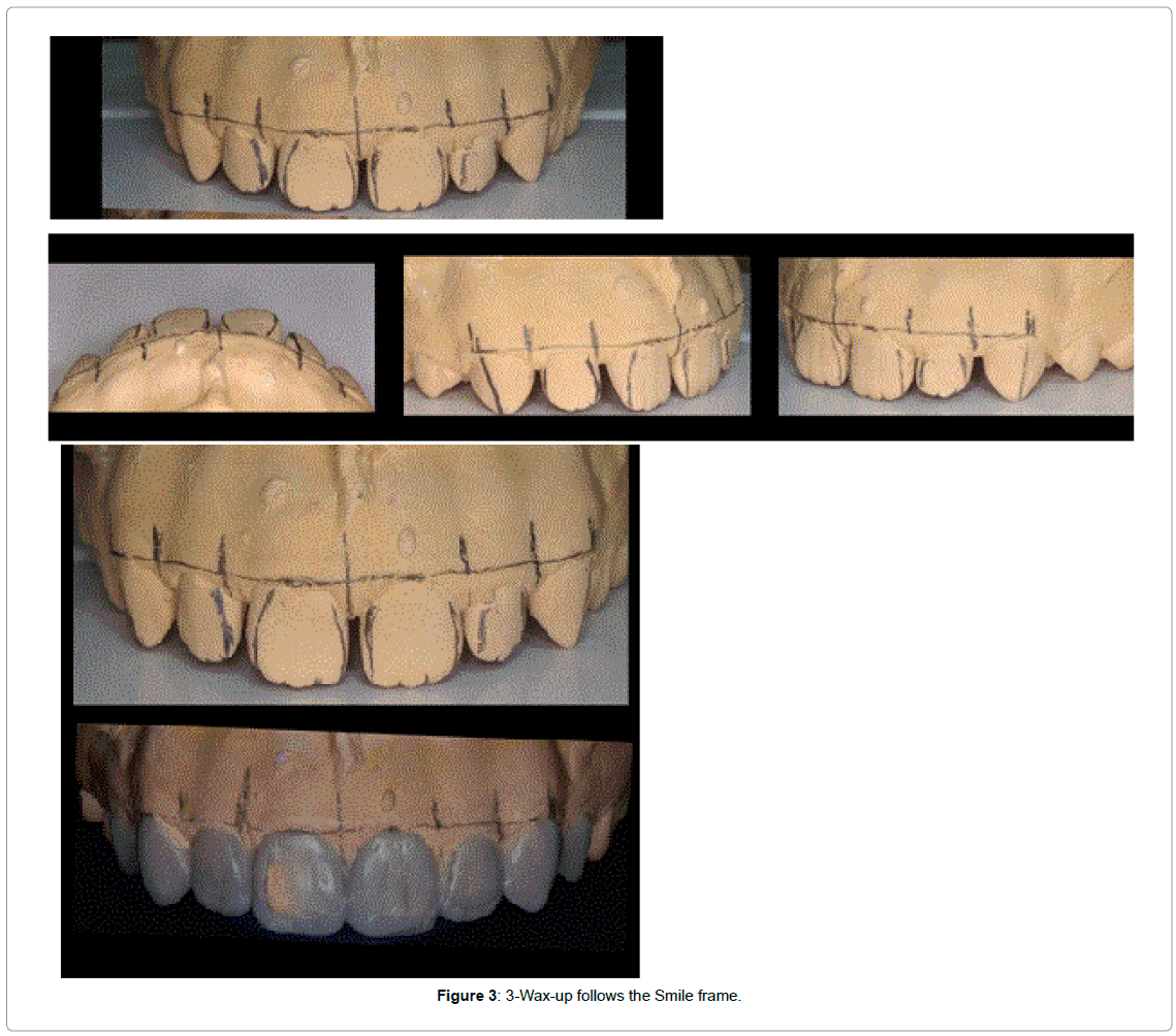 Bonded Functional Esthetic Prototypes (BFEPt): Review and a Case