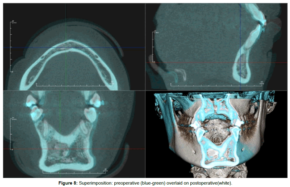 3D CBCT Superimposition Use in Evaluation of Simple Bone Cyst Lesion ...