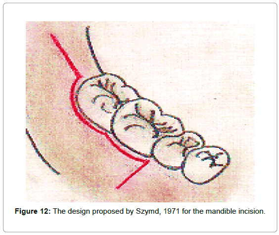 The Different Types of Flaps in the Surgical Relations of the Third ...