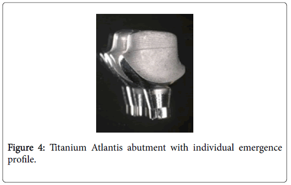 With Individualized Abutments to Achieve More Success in Implant
