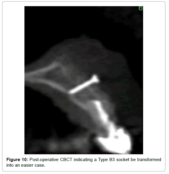 Socket Transformation: A Feasible Alternative before Immediate Im