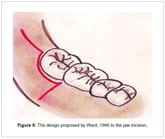 The Different Types of Flaps in the Surgical Relations of the Third ...