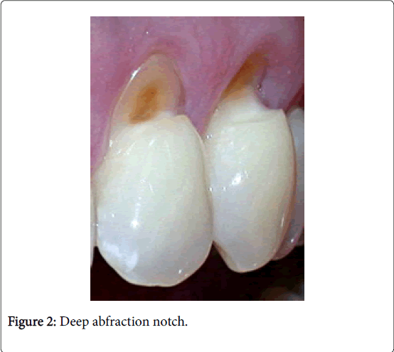 Noncarious Cervical Lesions as Abfraction: Etiology, Diagnosis, a