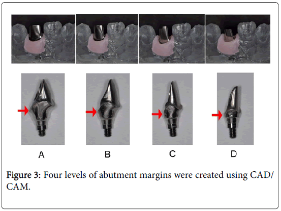 Effect of Margin Level Setting in Abutments Created by CAD/CAM on ...