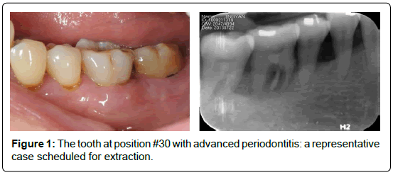Evaluation of Dental Implants Following Ridge Preservation in Molar ...