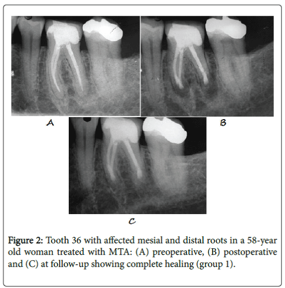 Periapical Surgery with IRM and MTA as Retrograde Root-end Fillings–A ...