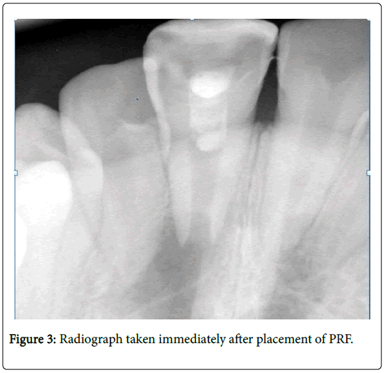 Tooth Discoloration and Internal Bleaching after the use of Triple ...