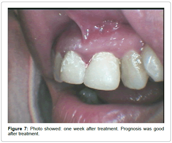 Multiple Applications with Er:YAG Laser in Apicoectomy - A Clinic