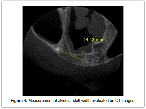 Clinical Evaluation of Bioabsorbable Mesh for Secondary Bone Grafts in ...