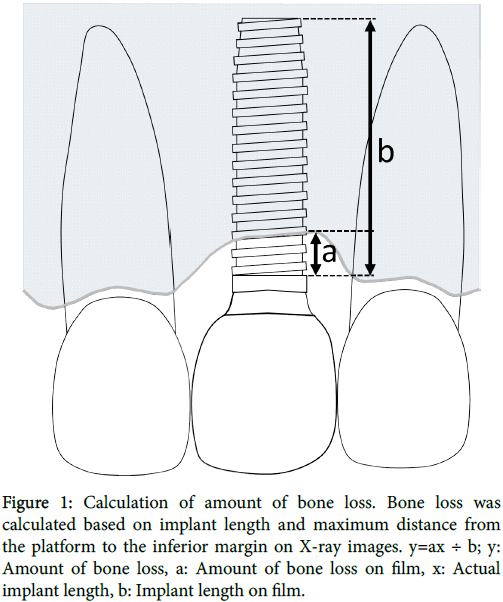 Peri-Implant Bone Loss Evaluation Around Dental Implants Placed into ...