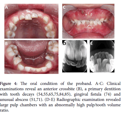 Mutation Survey of the PHEX Gene and Oral Manifestation in a Chinese ...