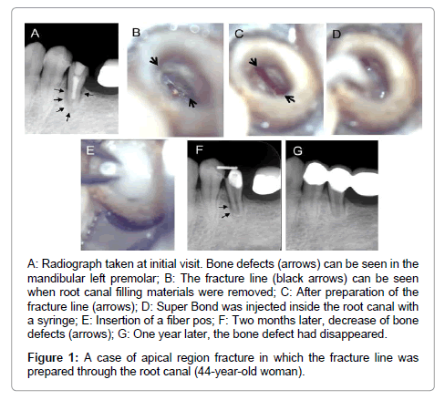 Sealing the Gap of Vertical Root Fracture through the Root Canal