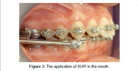 Evaluation Of Dentofacial Changes Caused With Sabbagh Universal Spring ...