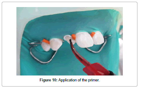 Bonding of all Ceramic Restorations