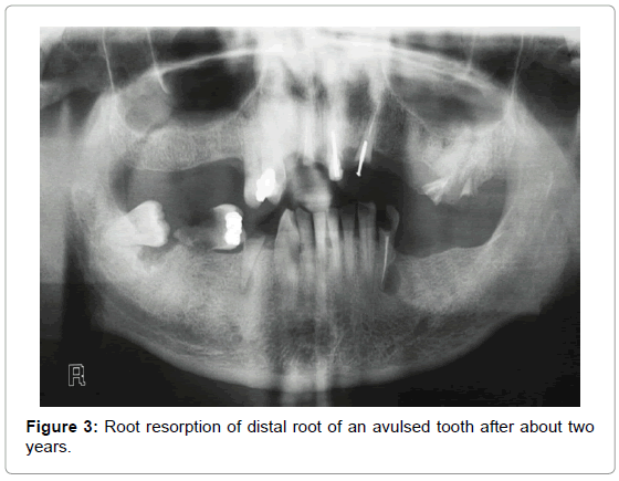 Introducing a new type of pathologic tooth migration in a patient