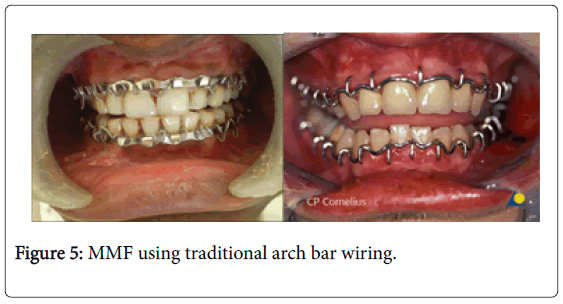 Use of Mandibulo-Maxillary Fixation Screws for the Treatment of ...