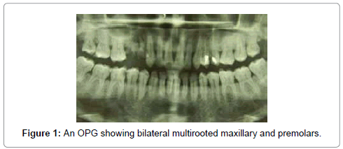 Multirooted- Bilateral Maxillary and Mandibular First and Second ...