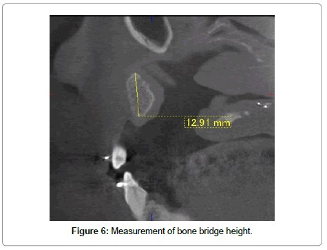 Clinical Evaluation of Bioabsorbable Mesh for Secondary Bone Grafts in ...