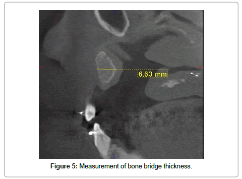 Clinical Evaluation of Bioabsorbable Mesh for Secondary Bone Grafts in ...