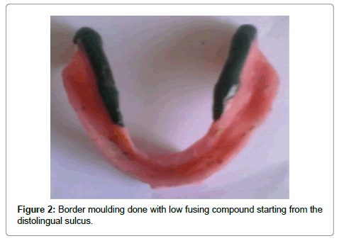 Sublingual Crescent Extension: A Solution for Loose Lower Denture-A ...