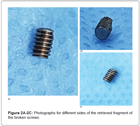 The use of Dental Operating Microscope for Retrieval of different