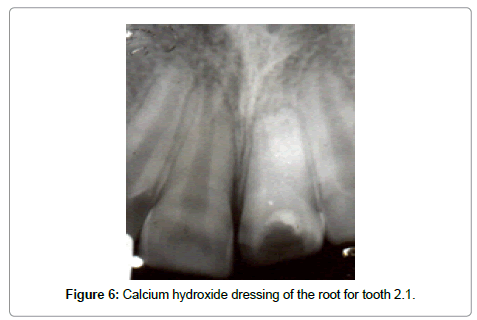 The Management of Crown Fracture of Immature Teeth by MTA and Cal