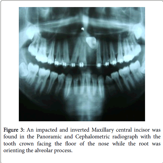 Orthodontic and Surgical Treatment in an Inverted Maxillary Impacted ...
