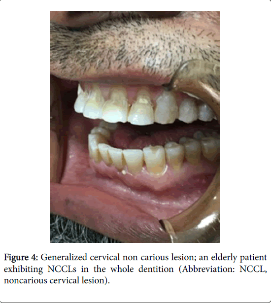 Noncarious Cervical Lesions as Abfraction: Etiology, Diagnosis, a