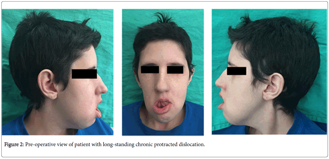 Surgical Management of Chronic and Refractory TMJ Dislocation in