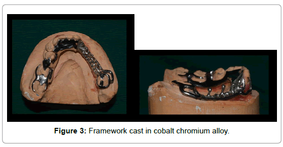 Prosthetic Rehabilitation of a Patient with Ameloblastoma using an ...