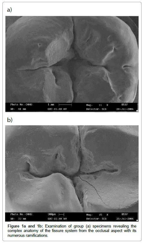 Morphology of Pits and Fissures Reviewed through Scanning Electro