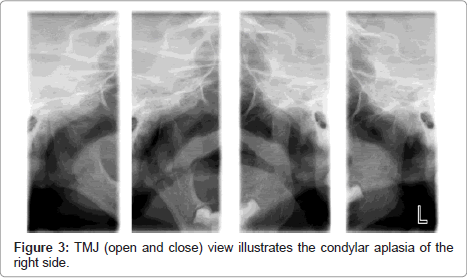 Morphological and Radiological Variations of Mandibular Condyles