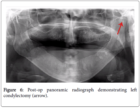 Surgical Management of Chronic and Refractory TMJ Dislocation in