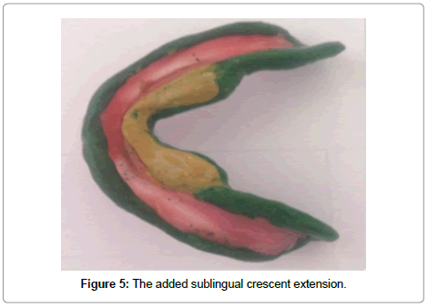 Sublingual Crescent Extension: A Solution for Loose Lower Denture-A ...