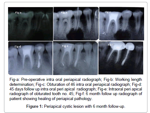 Non-Surgical Management of Periapical Cystic Lesion- A Case Report