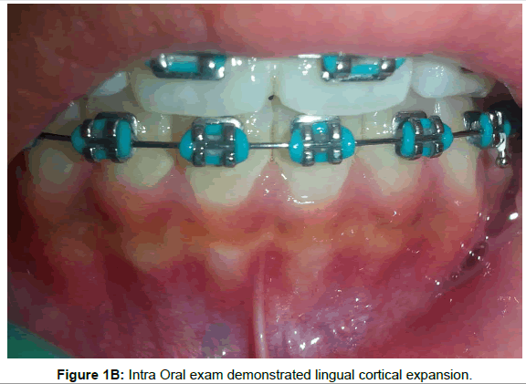 3D CBCT Superimposition Use in Evaluation of Simple Bone Cyst Lesion ...