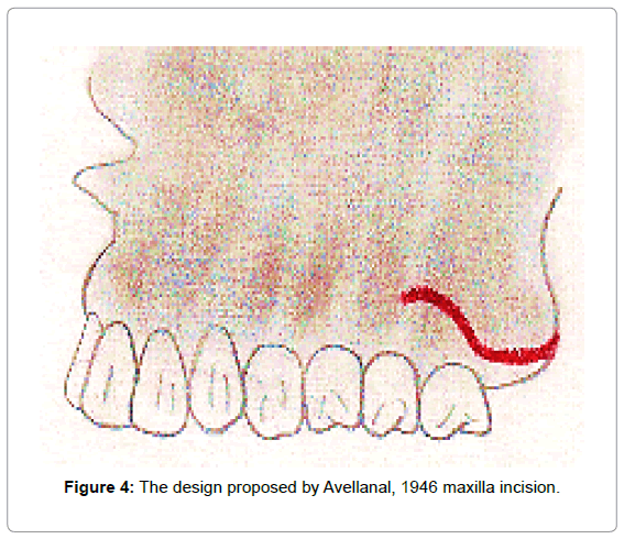 The Different Types of Flaps in the Surgical Relations of the Third ...