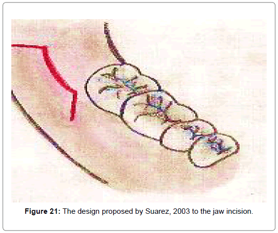 The Different Types of Flaps in the Surgical Relations of the Third ...