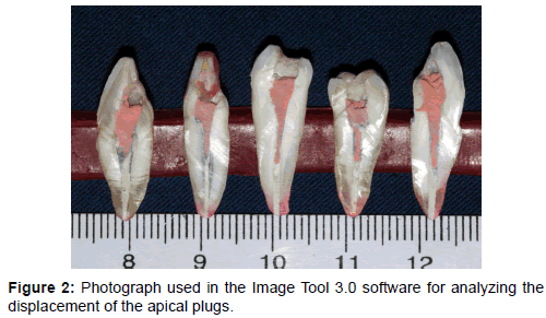 Displacement Of Apical Plugs Fabricated From Calcium Hydroxide Paste In ...