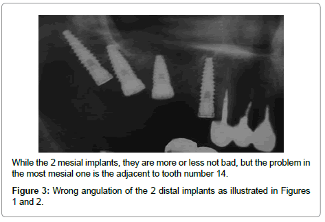 Implant Success versus Implant Survival