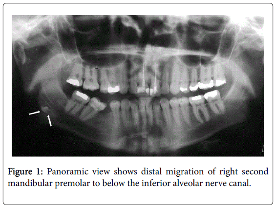 Intra-Osseous Migration of Second Lower Premolar-Literature Revie