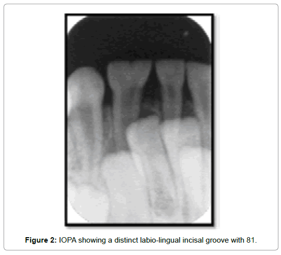 Gemination Or Fusion? A Diagnostic Dilemma