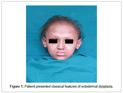 A Unique Approach to Retain Dentures in a Patient with Hypohidrot